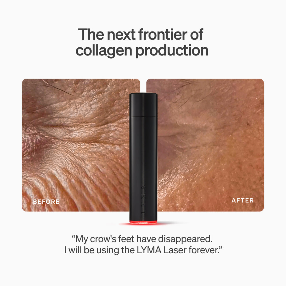 Shop the LYMA Laser – The Most Powerful At-Home Skincare Laser in US