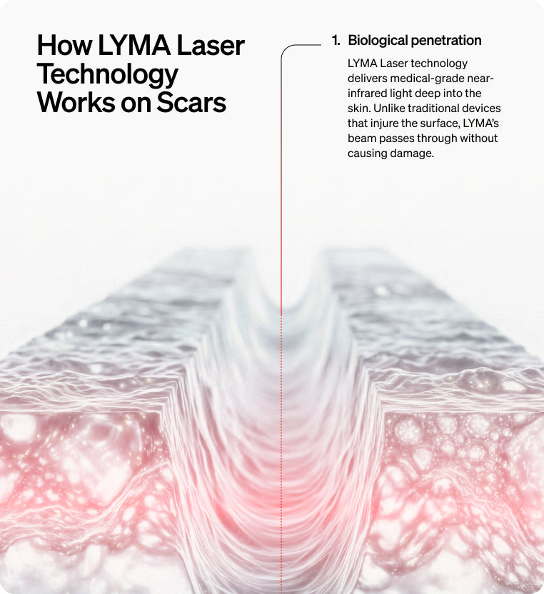 The LYMA Laser: Advanced Scar Treatment for Flawless Skin