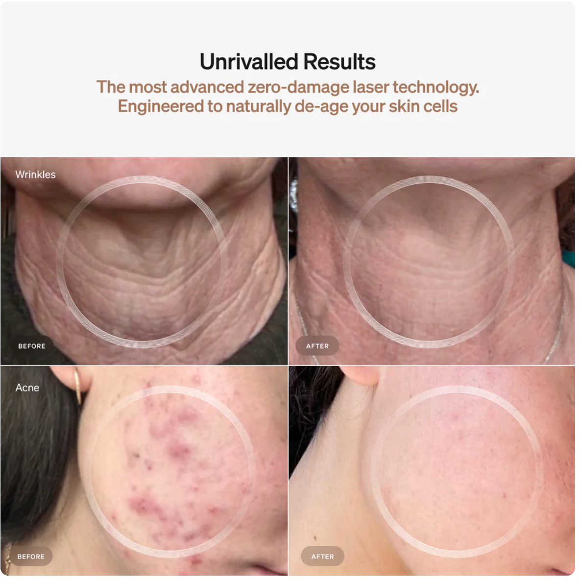 Shop The LYMA Laser, Free Shipping. Power to Transform Your Skin