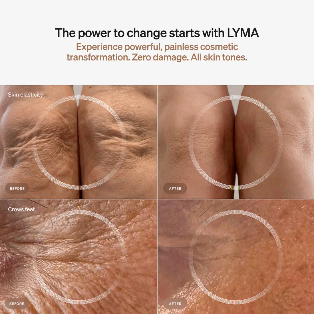 Shop The LYMA Laser: Pay in up to 12 Instalments. Free Express Shipping.