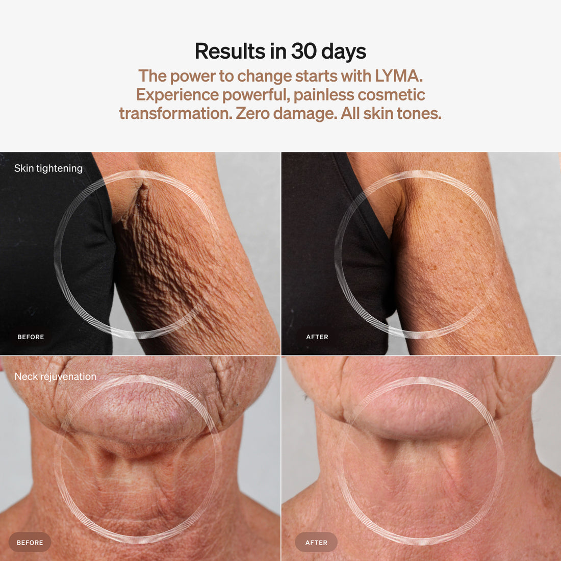 Shop The LYMA Laser PRO. Pay in up to 12 Instalments. Free Shipping