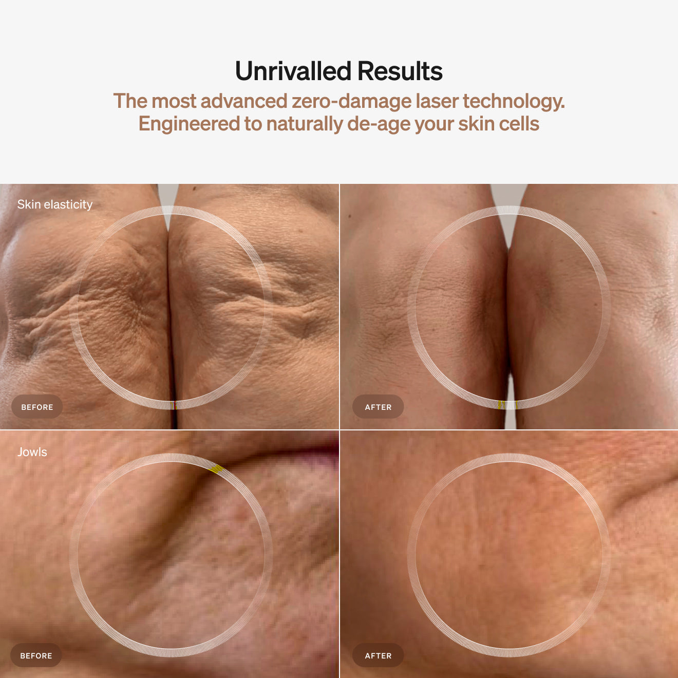 The LYMA Laser Power To Change: At-Home Laser Skin Treatment