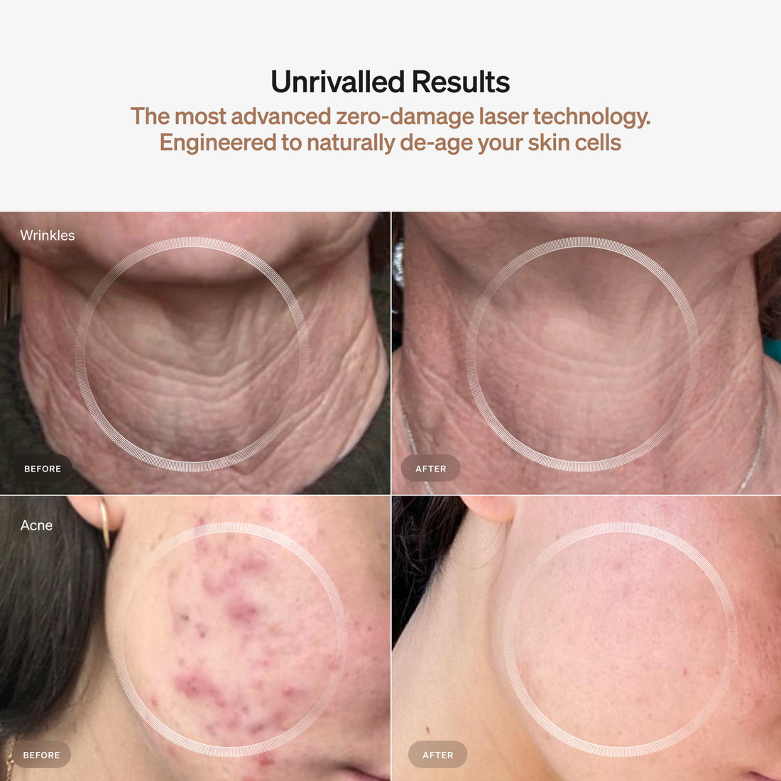 The LYMA Laser Power To Change: At-Home Laser Skin Treatment