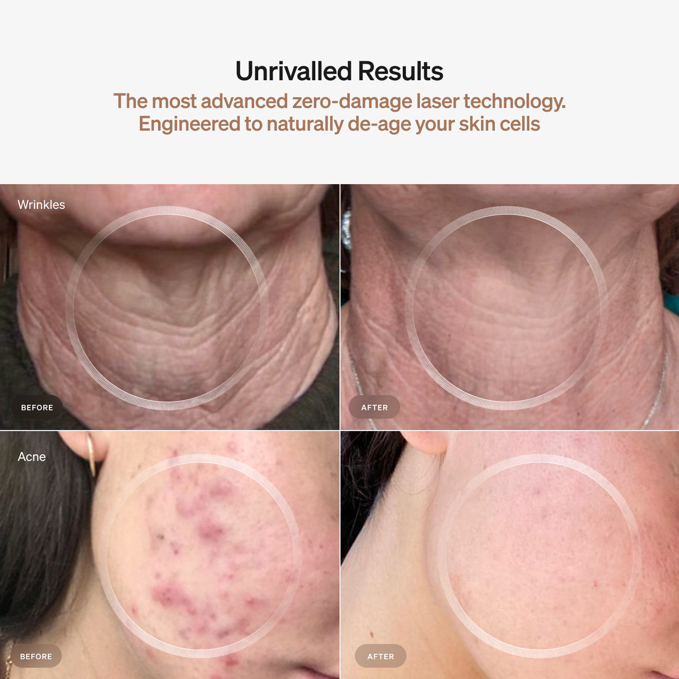 The LYMA Laser Power To Change: At-Home Laser Skin Treatment